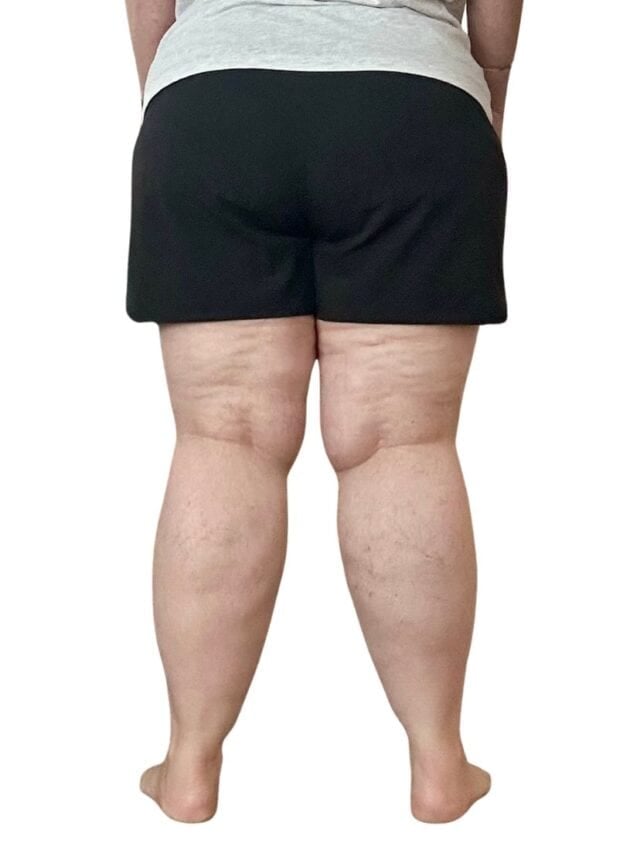 What is Lipedema? - Love Your Body Well